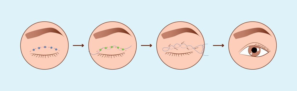 Blepharoplasty - Eyelid Surgery- Eyelid Lift Before after- Photos- Pictures