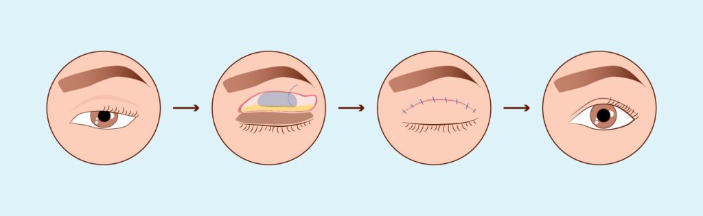 Blepharoplasty - Eyelid Surgery- Eyelid Lift Before after- Photos- Pictures