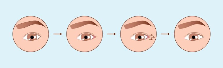 Blepharoplasty - Eyelid Surgery- Eyelid Lift Before after- Photos- Pictures