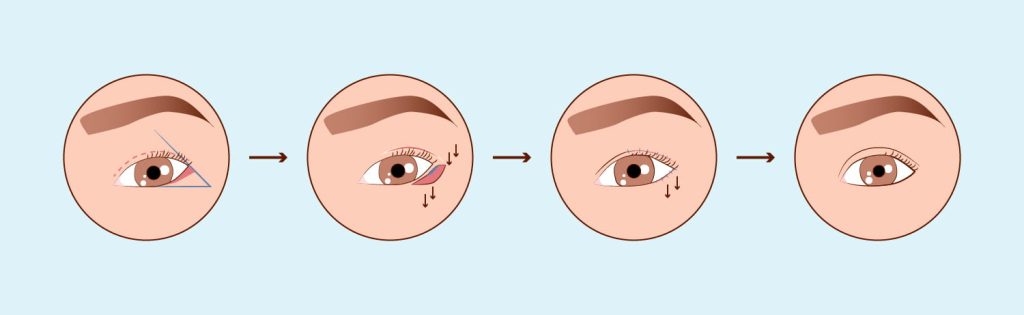 Blepharoplasty - Eyelid Surgery- Eyelid Lift Before after- Photos- Pictures