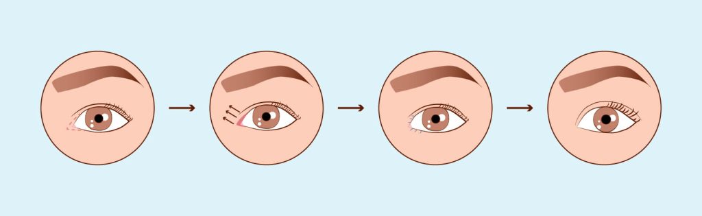 Blepharoplasty - Eyelid Surgery- Eyelid Lift Before after- Photos- Pictures